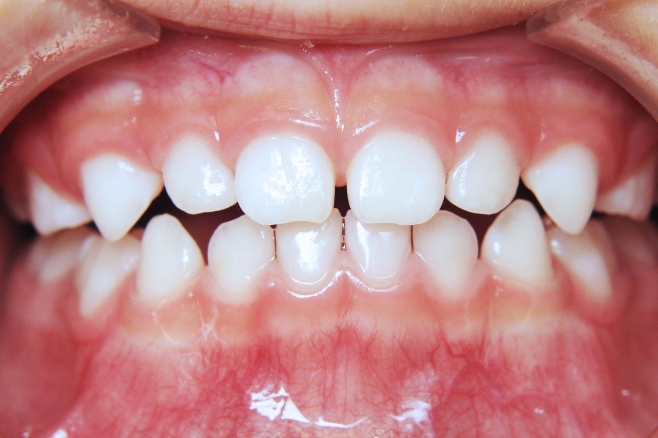 Lift the Lip Program • SA Dental